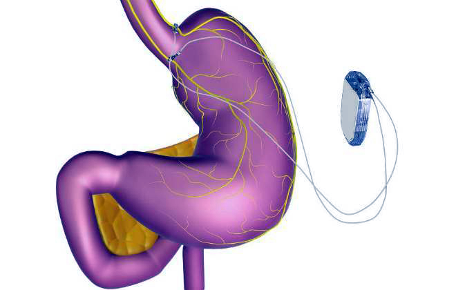 Procedimento minimamente invasivo para tratar o refluxo – Revista RMC